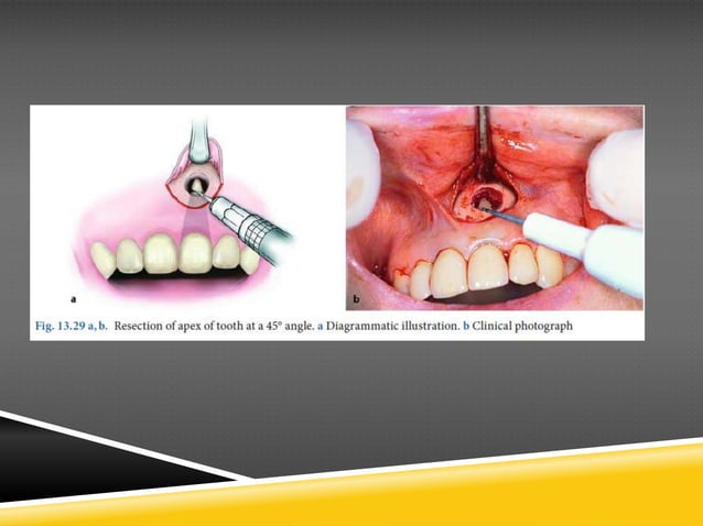 apicoectomy | PPTX