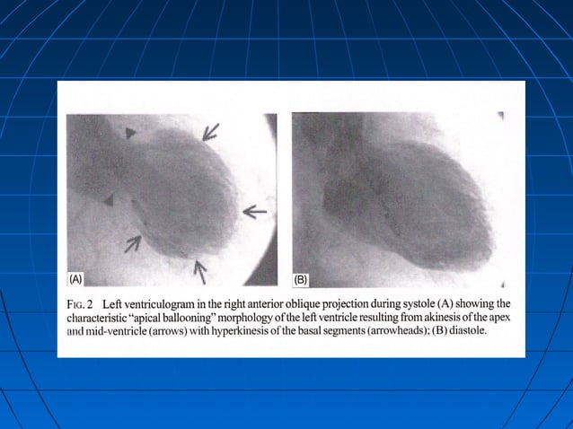 Apical Ballooning Syndrome | PPT