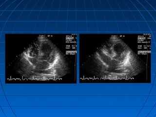 Apical Ballooning Syndrome | PPT