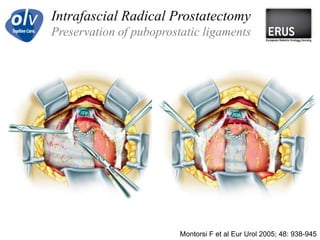 Apical dissection athens 2011 | PPTX