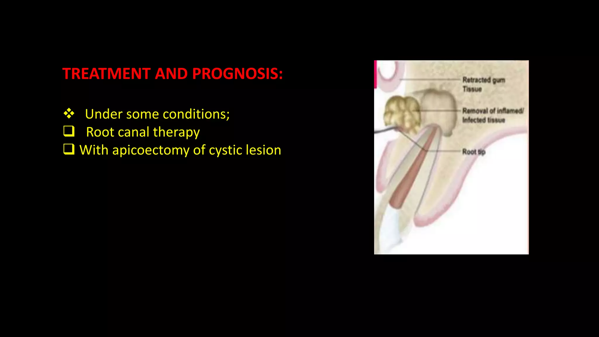 Apical lesions in dentistry | PPTX