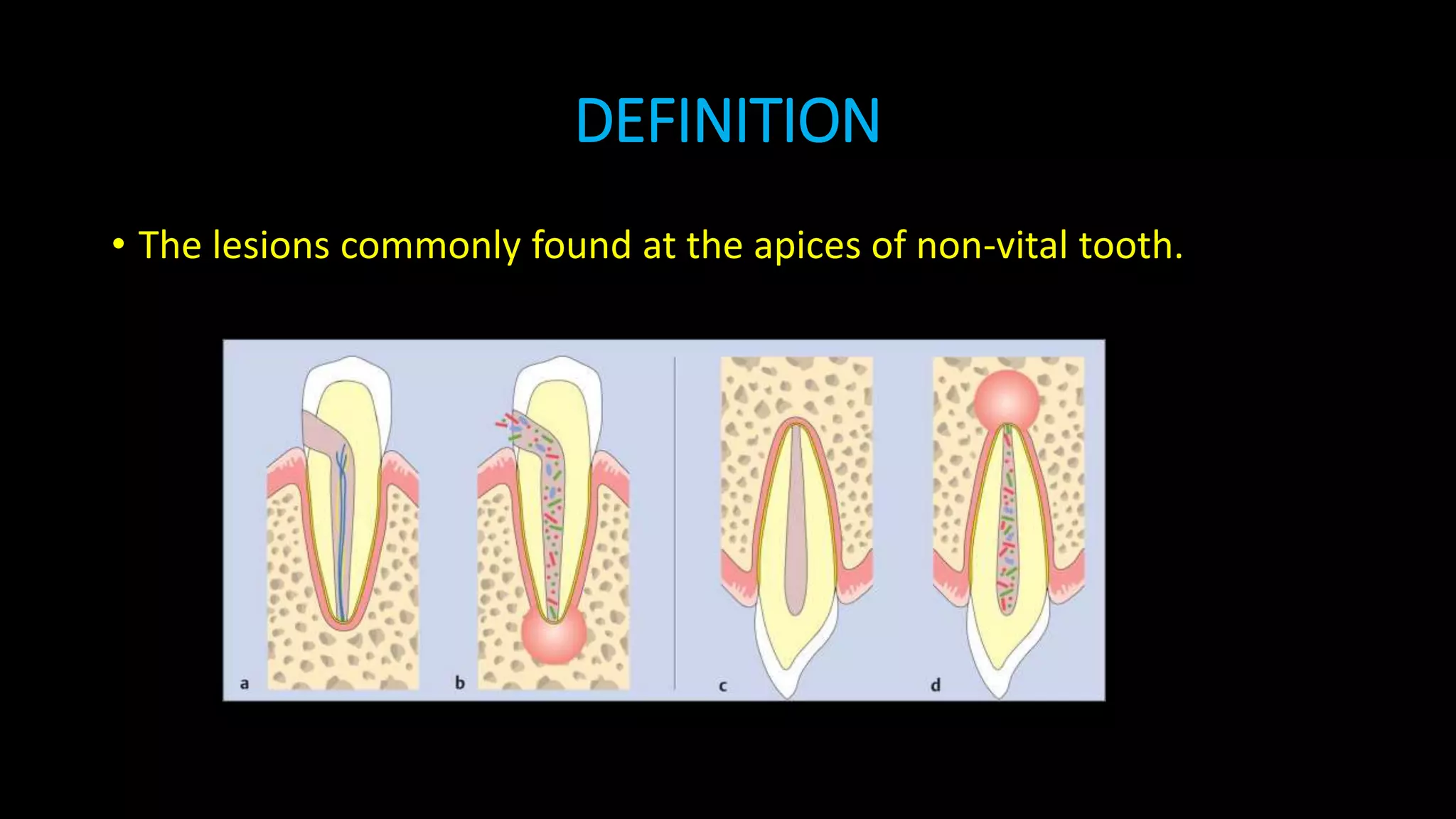 Apical lesions in dentistry | PPTX | Dental Health | Diseases and ...
