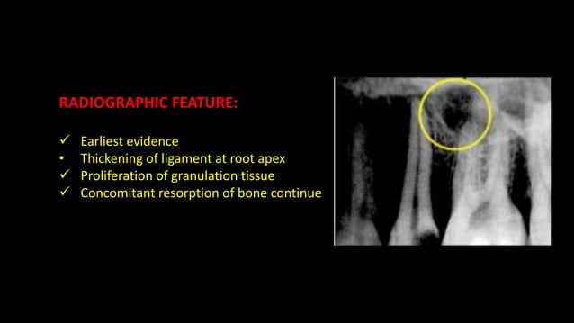 Apical lesions in dentistry | PPT