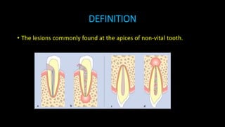 Apical lesions in dentistry | PPTX | Dental Health | Diseases and ...