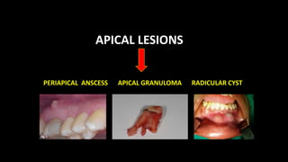 Apical lesions in dentistry | PPTX | Dental Health | Diseases and ...