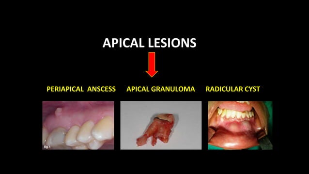 Apical lesions in dentistry | PPT