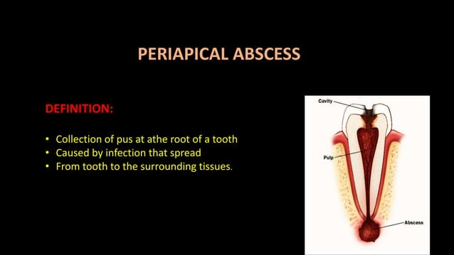 Apical lesions in dentistry | PPTX | Dental Health | Diseases and ...