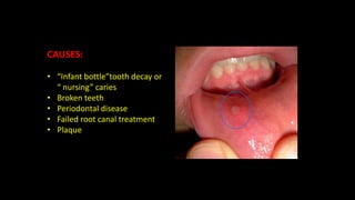 Apical lesions in dentistry | PPTX