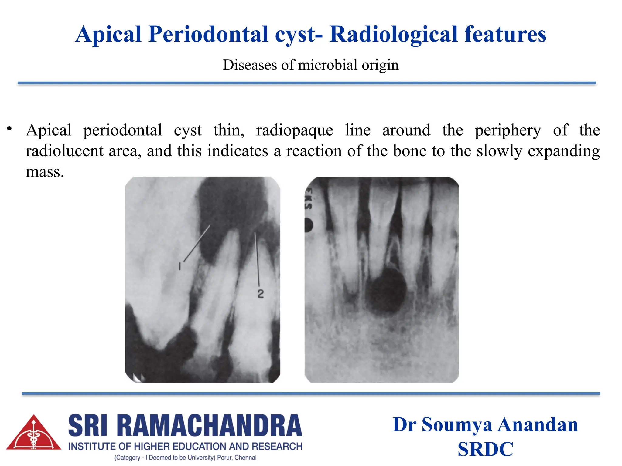 Apical peridontal cyst, Periapical abscess.pptx