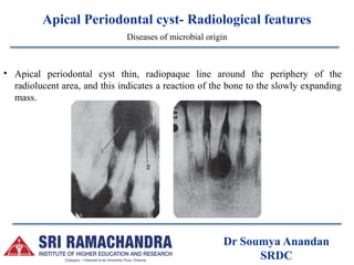 Apical peridontal cyst, Periapical abscess.pptx