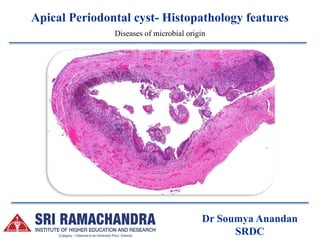 Apical peridontal cyst, Periapical abscess.pptx