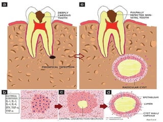 Apical peridontal cyst, Periapical abscess.pptx