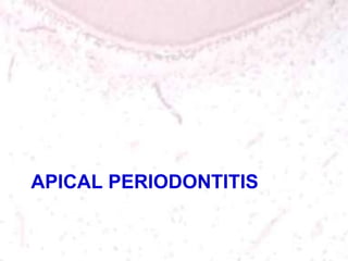Apical periodontitis. tooth inflammation.ppt