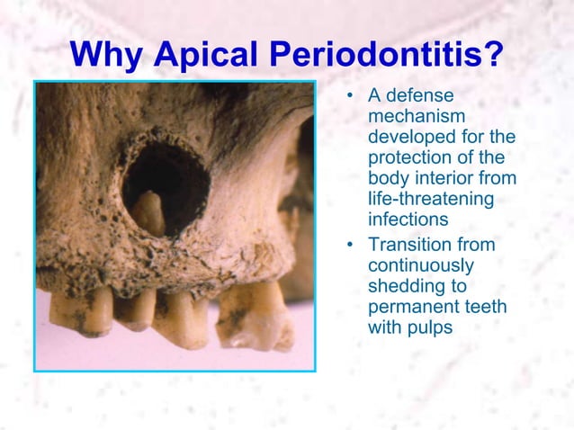Apical periodontitis. tooth inflammation.ppt | Dental Health | Diseases ...