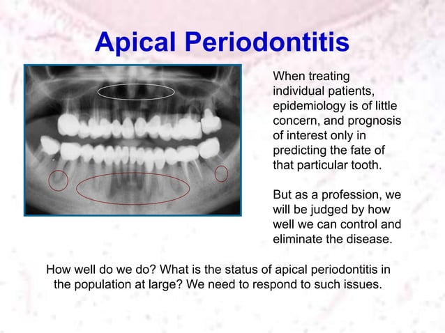 Apical periodontitis. tooth inflammation.ppt | Dental Health | Diseases ...