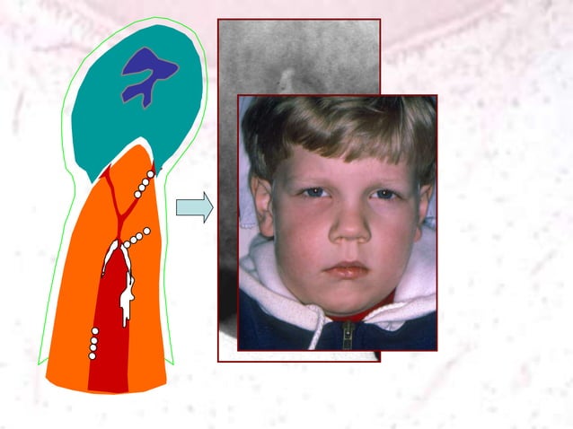 Apical periodontitis. tooth inflammation.ppt | Dental Health | Diseases ...