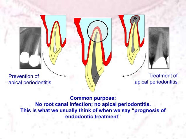 Apical periodontitis. tooth inflammation.ppt | Dental Health | Diseases ...
