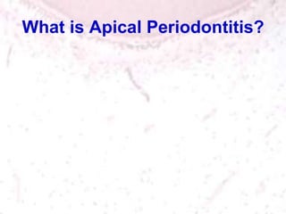 Apical periodontitis. tooth inflammation.ppt