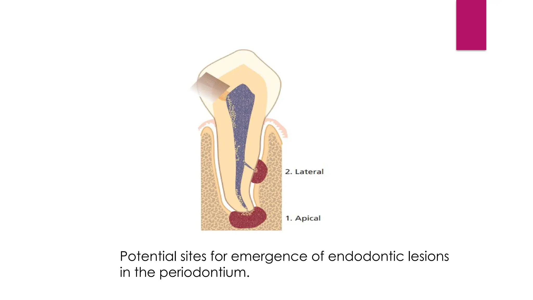 APICAL PERIODONTITIS AND ROOT CANAL TREATMENT.pptx