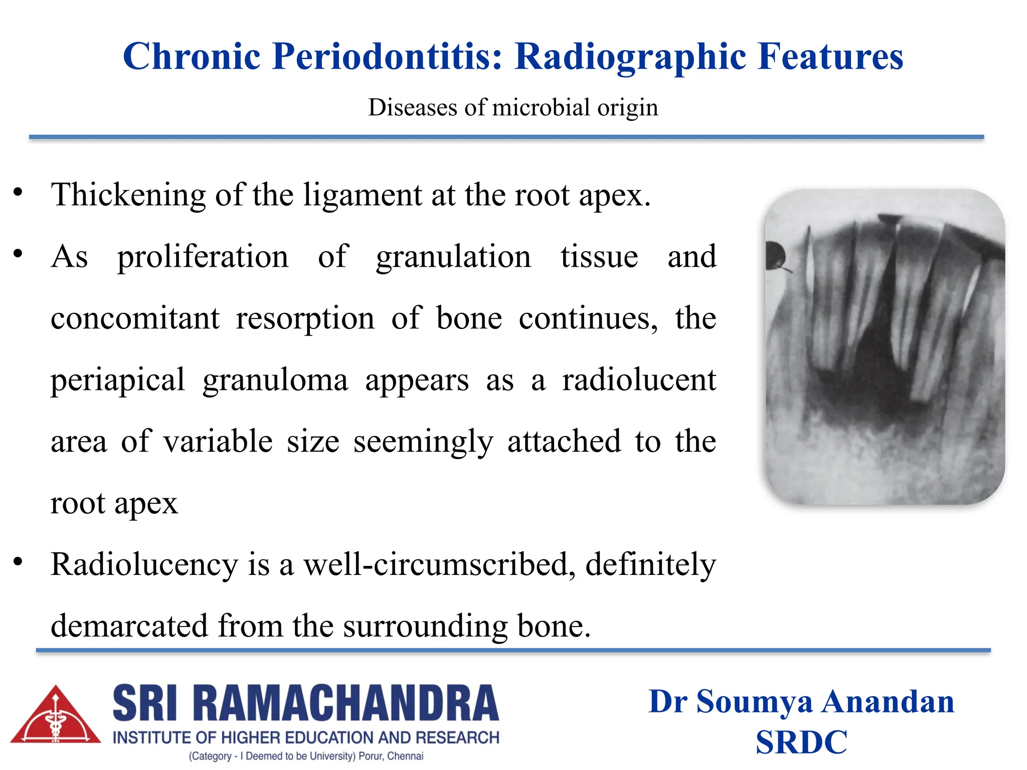 Apical Periodontitis- Dr Soumya Anandan.pptx