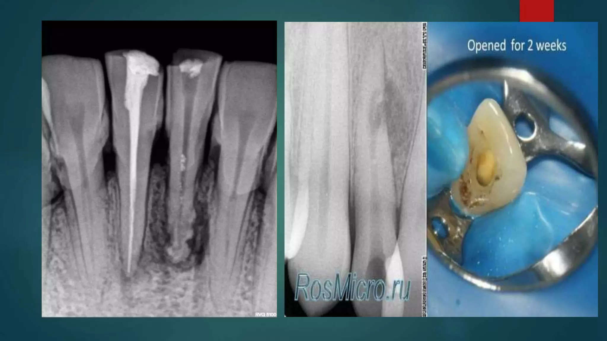APICAL THIRD PPT.pptx