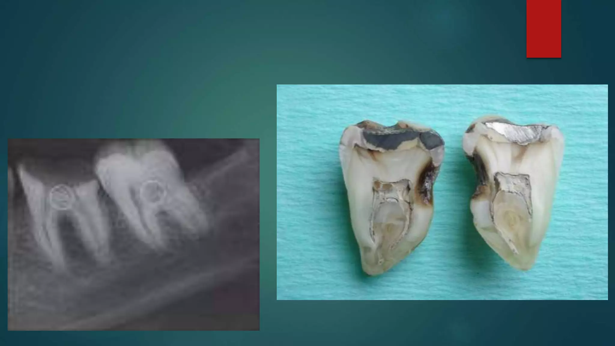 APICAL THIRD PPT.pptx