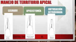 Apicectomia | PPTX