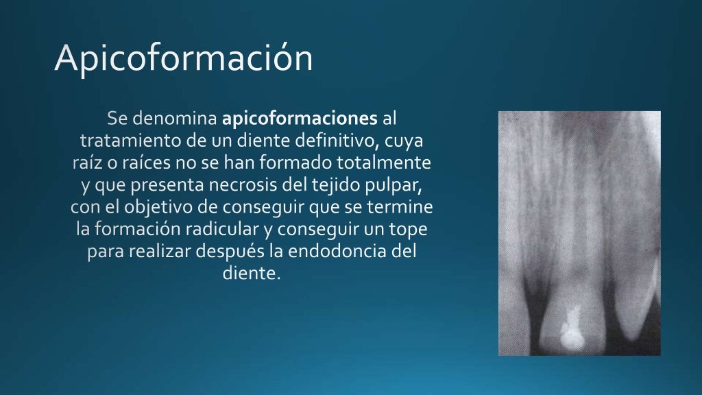 Apicogenesis apicoformacion