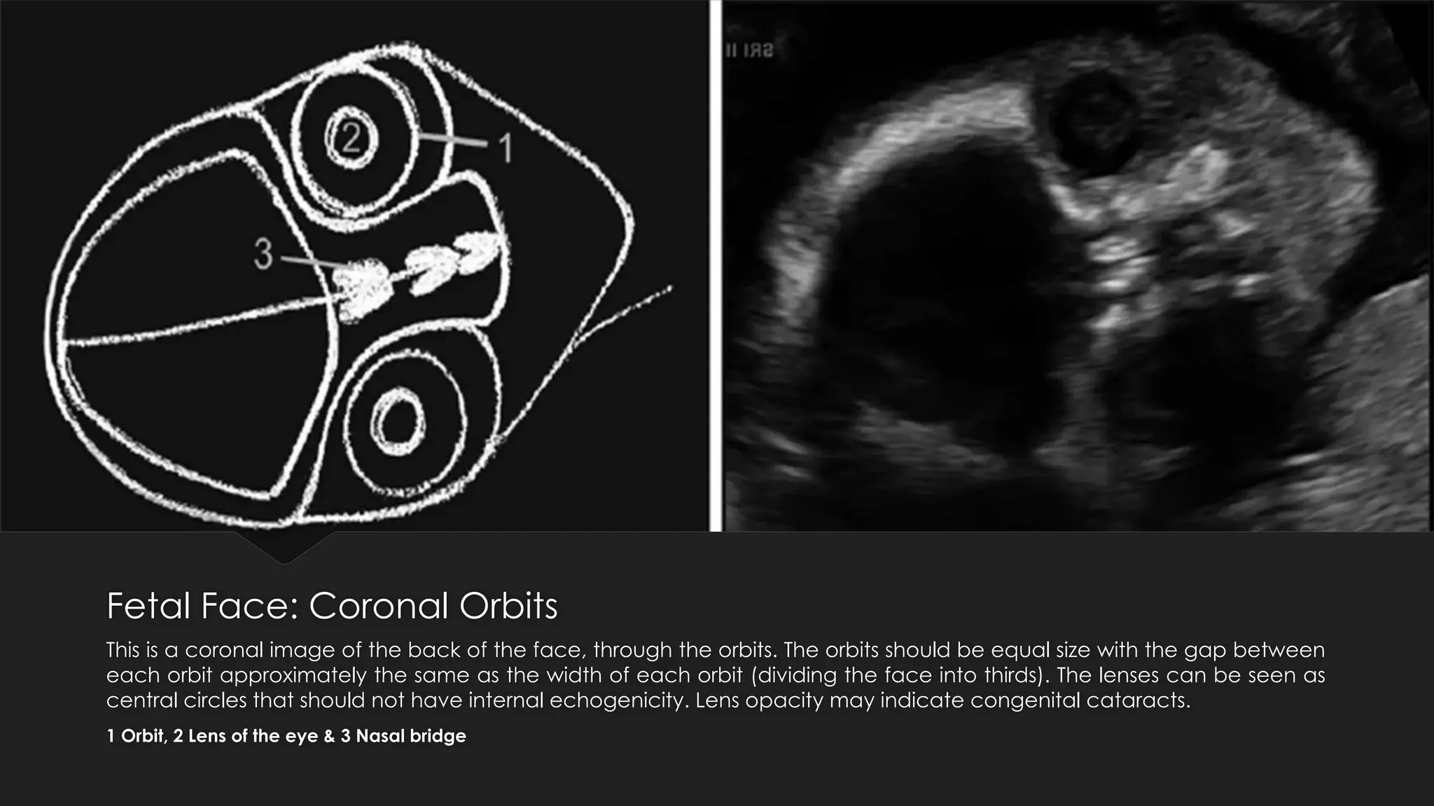 A pictorial guide for the 2nd Trimester USG | PPTX