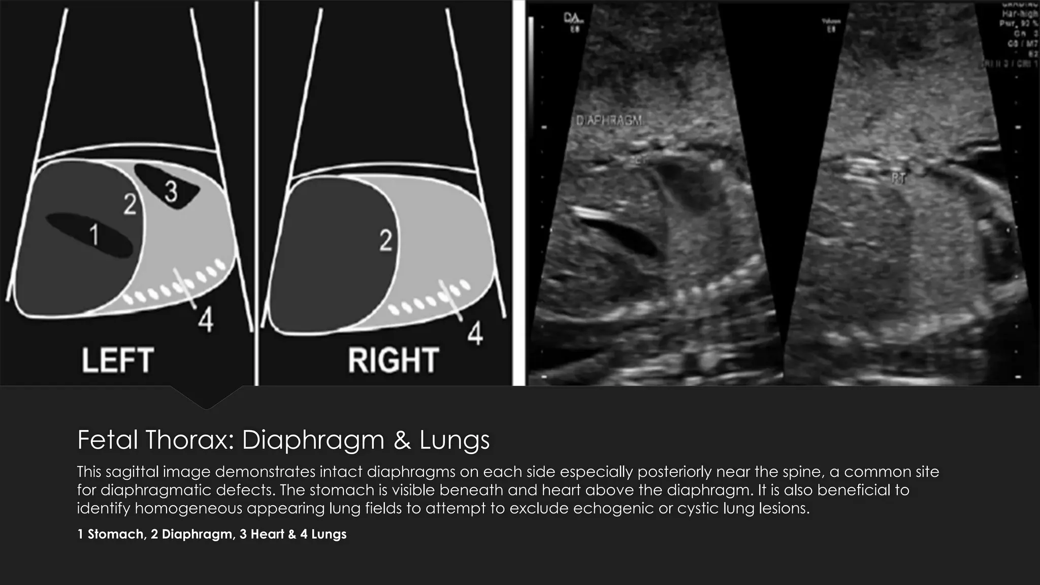 A pictorial guide for the 2nd Trimester USG | PPTX