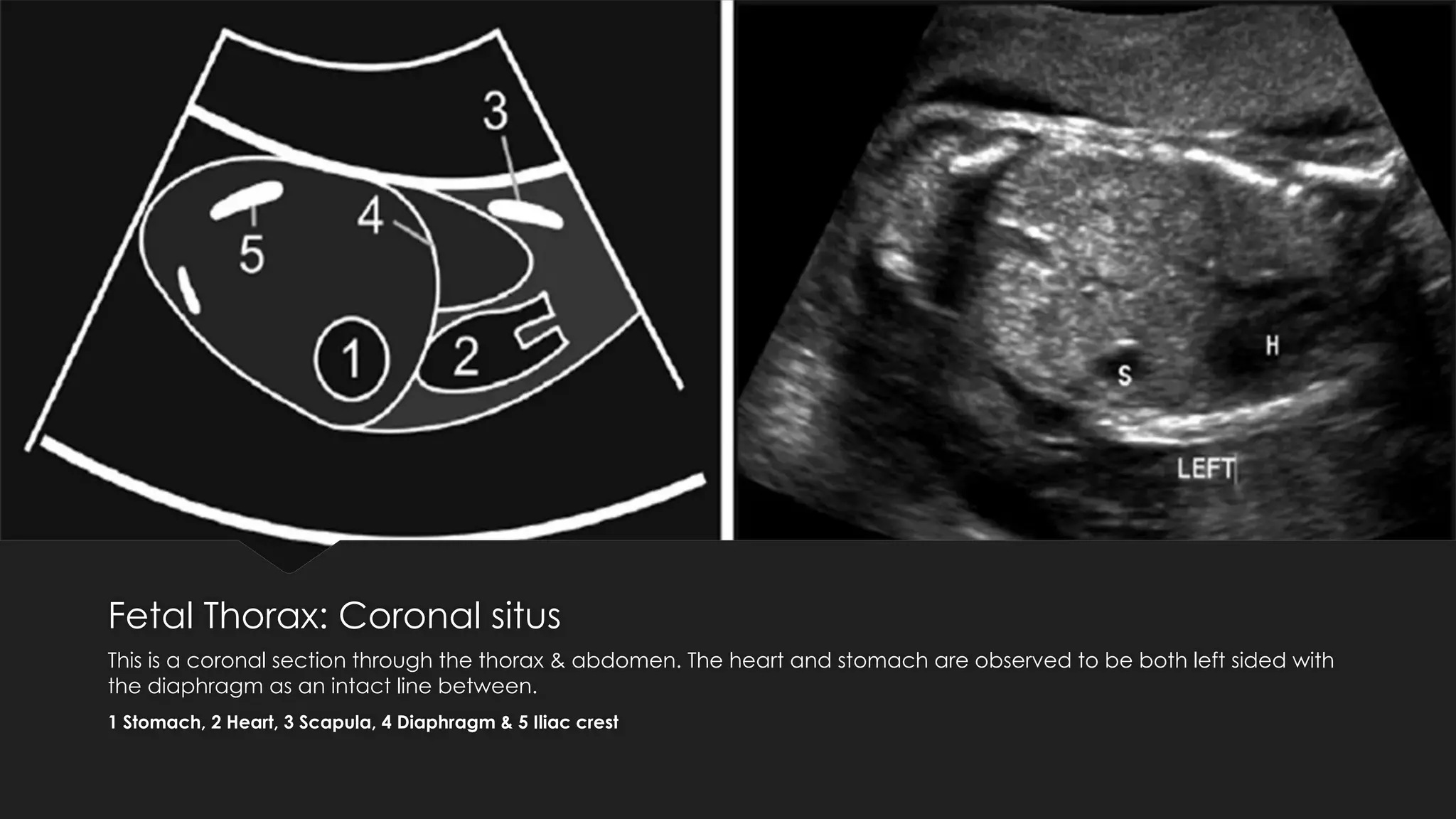 A pictorial guide for the 2nd Trimester USG | PPTX