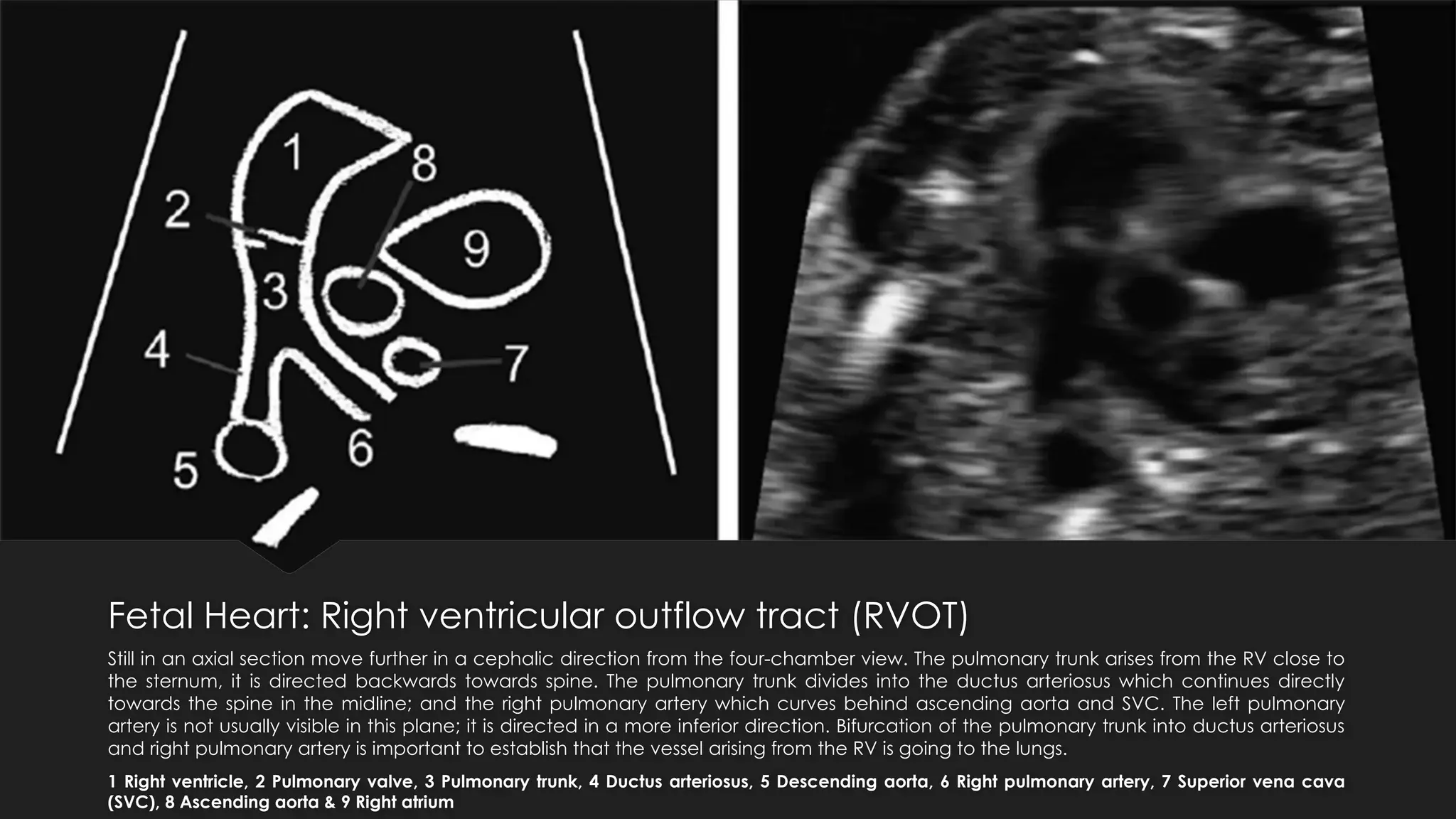 A pictorial guide for the 2nd Trimester USG | PPTX