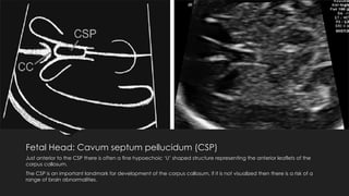 A pictorial guide for the 2nd Trimester USG | PPTX