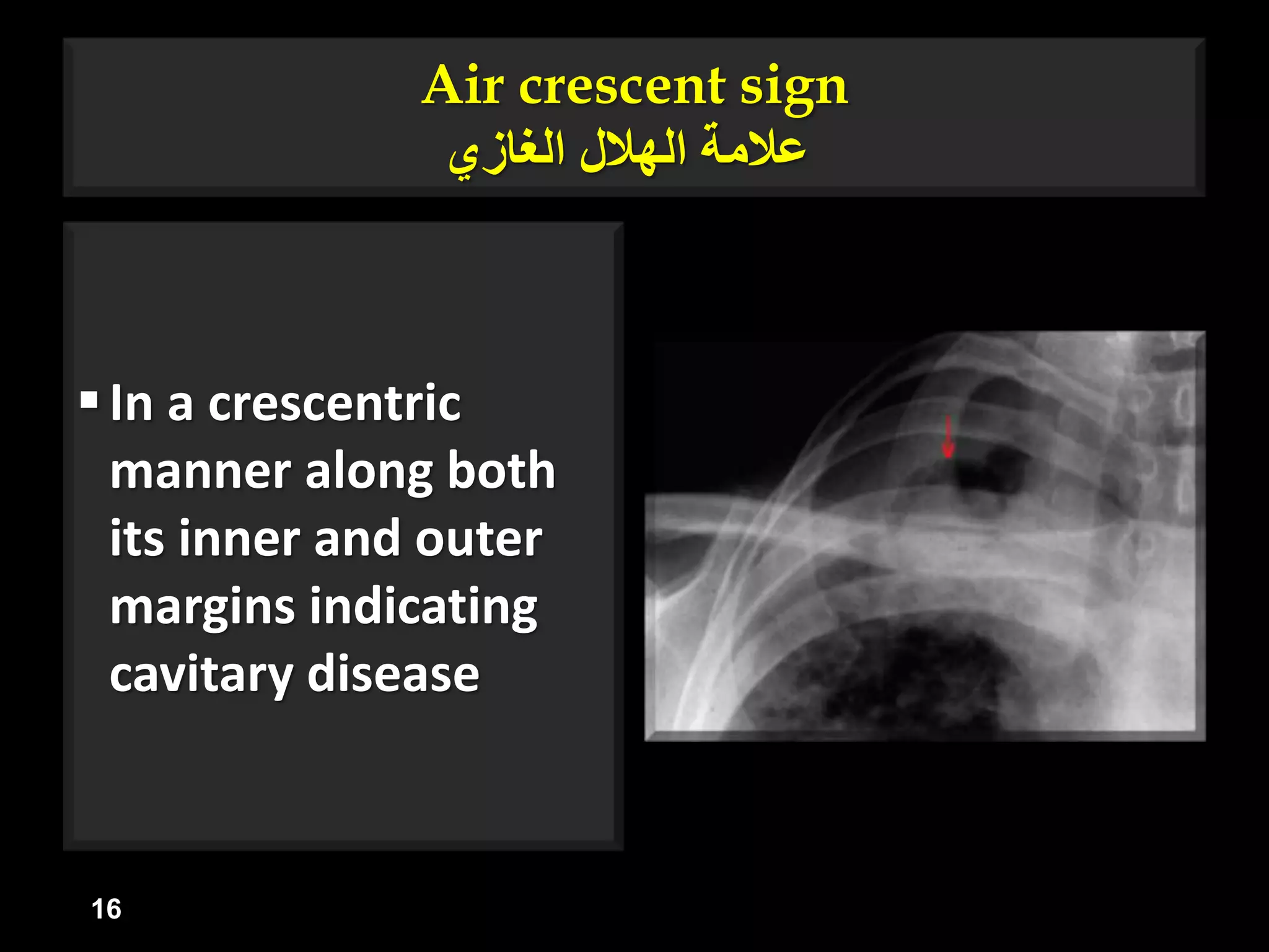 A pictorial review of “signs in thoracic imaging 01” | PPT