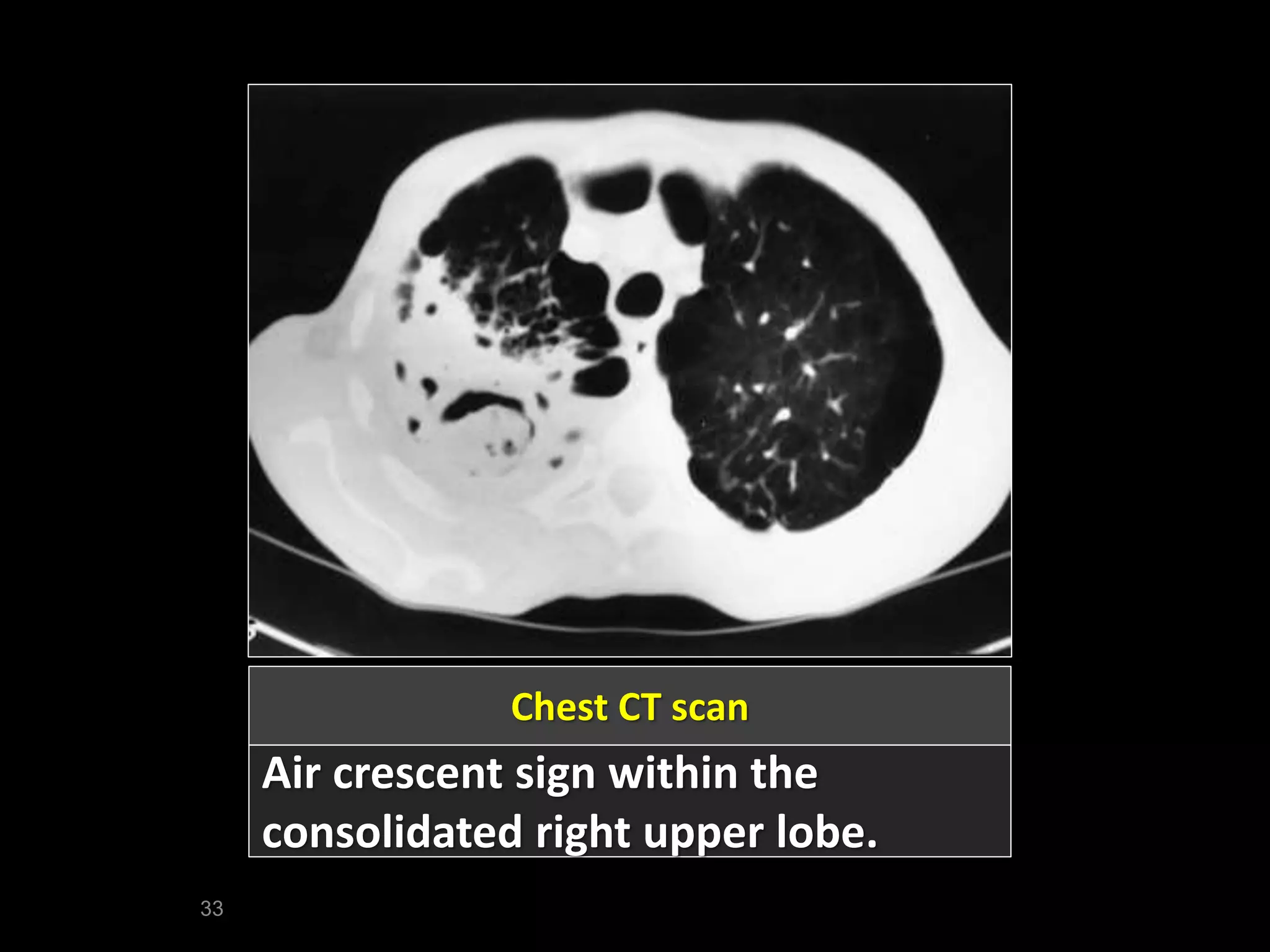 A pictorial review of “signs in thoracic imaging 01” | PPT