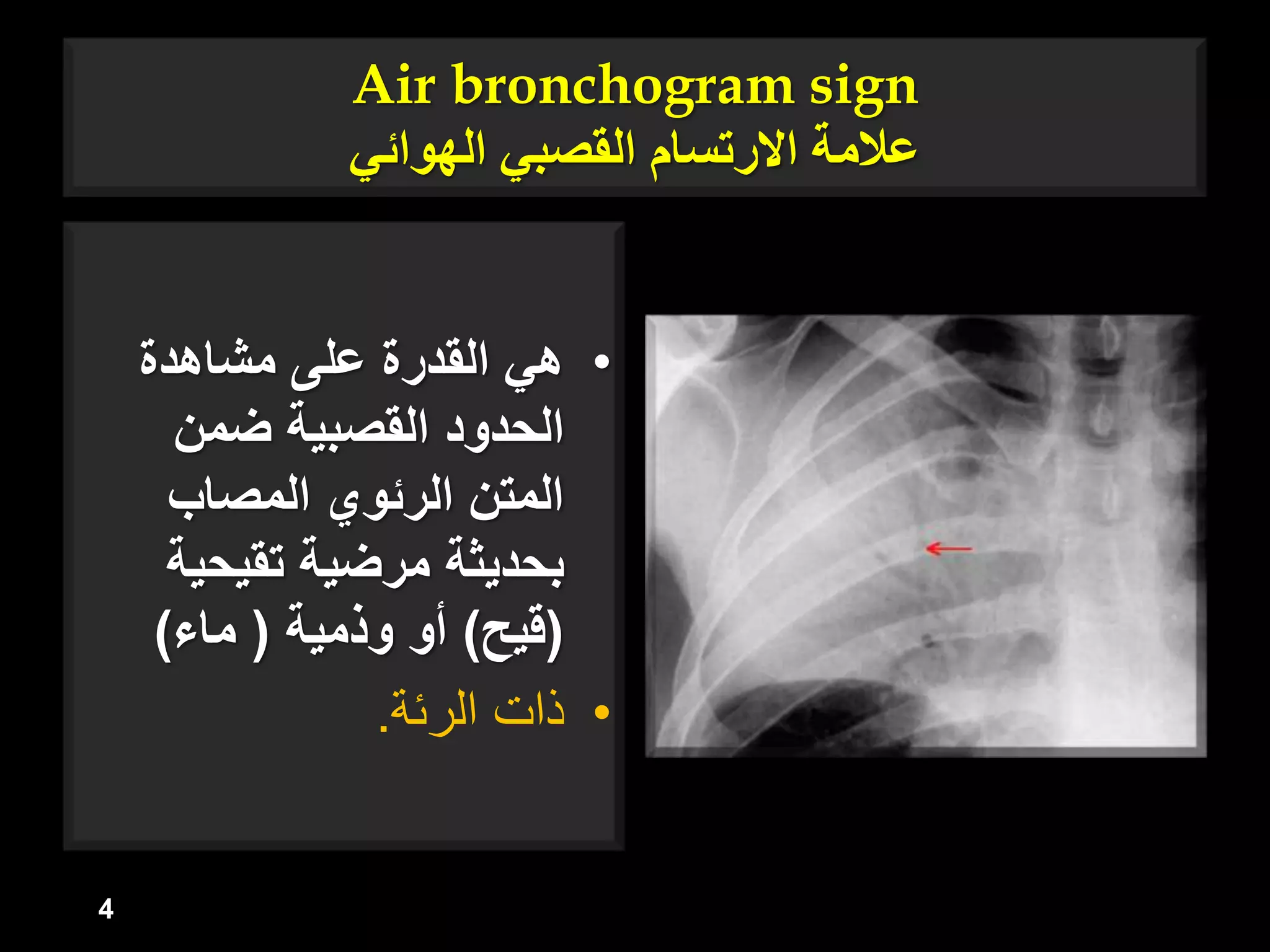 A pictorial review of “signs in thoracic imaging 01” | PPT