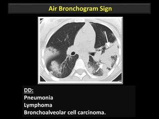 A pictorial review of “signs in thoracic imaging 01” | PPT