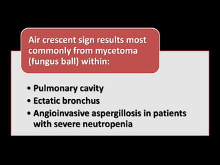 A pictorial review of “signs in thoracic imaging 01” | PPT