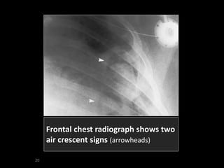 A pictorial review of “signs in thoracic imaging 01” | PPT