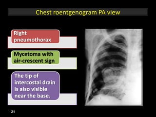 A pictorial review of “signs in thoracic imaging 01” | PPT