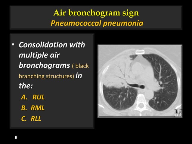 A pictorial review of “signs in thoracic imaging 01” | PPT