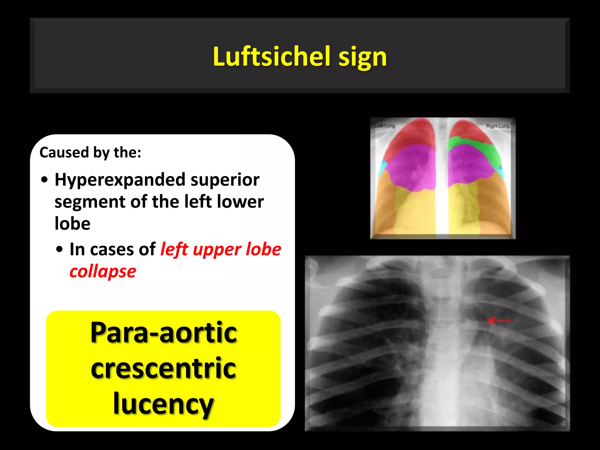 A pictorial review of “signs in thoracic imaging 02” | PPTX