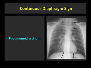 Continuous Diaphragm Sign