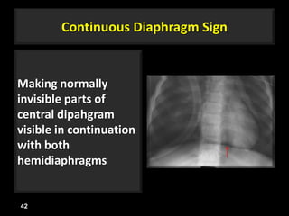 Continuous Diaphragm Sign