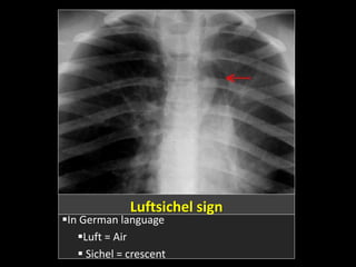 A pictorial review of “signs in thoracic imaging 02” | PPT