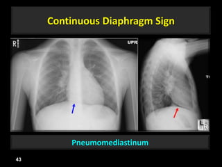 Continuous Diaphragm Sign