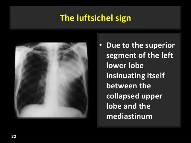 A pictorial review of “signs in thoracic imaging 02”