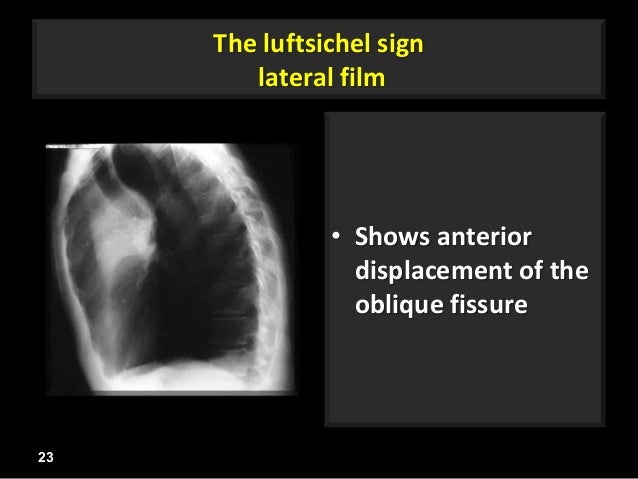 A pictorial review of “signs in thoracic imaging 02”