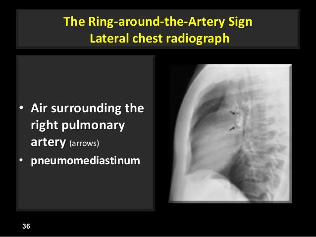 A pictorial review of “signs in thoracic imaging 02”