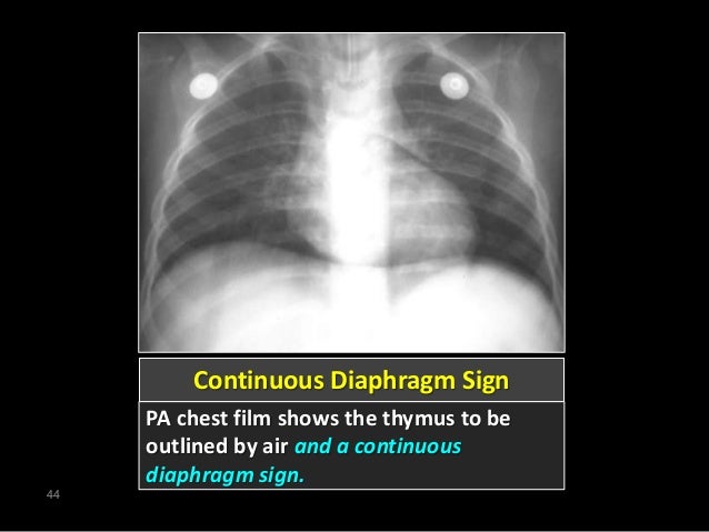 A pictorial review of “signs in thoracic imaging 02”